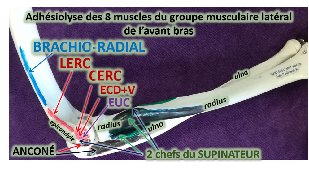 Ostéopathie du Coude : Épicondylalgie latérale