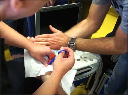 libération capsule cheville | Adhésiolyse Manuelle Dynamique®