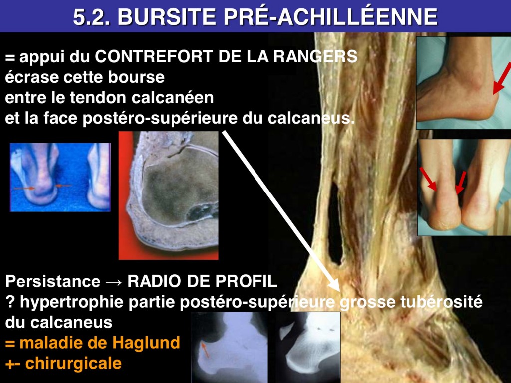 ostéopathie et Bursite pré-achilléenne | Adhésiolyse Manuelle Dynamique®