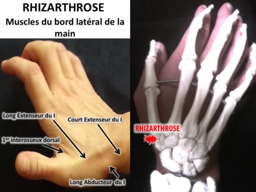 Douleur du Pouce par Rhizarthrose: Ostéopathie - Adhésiolyse